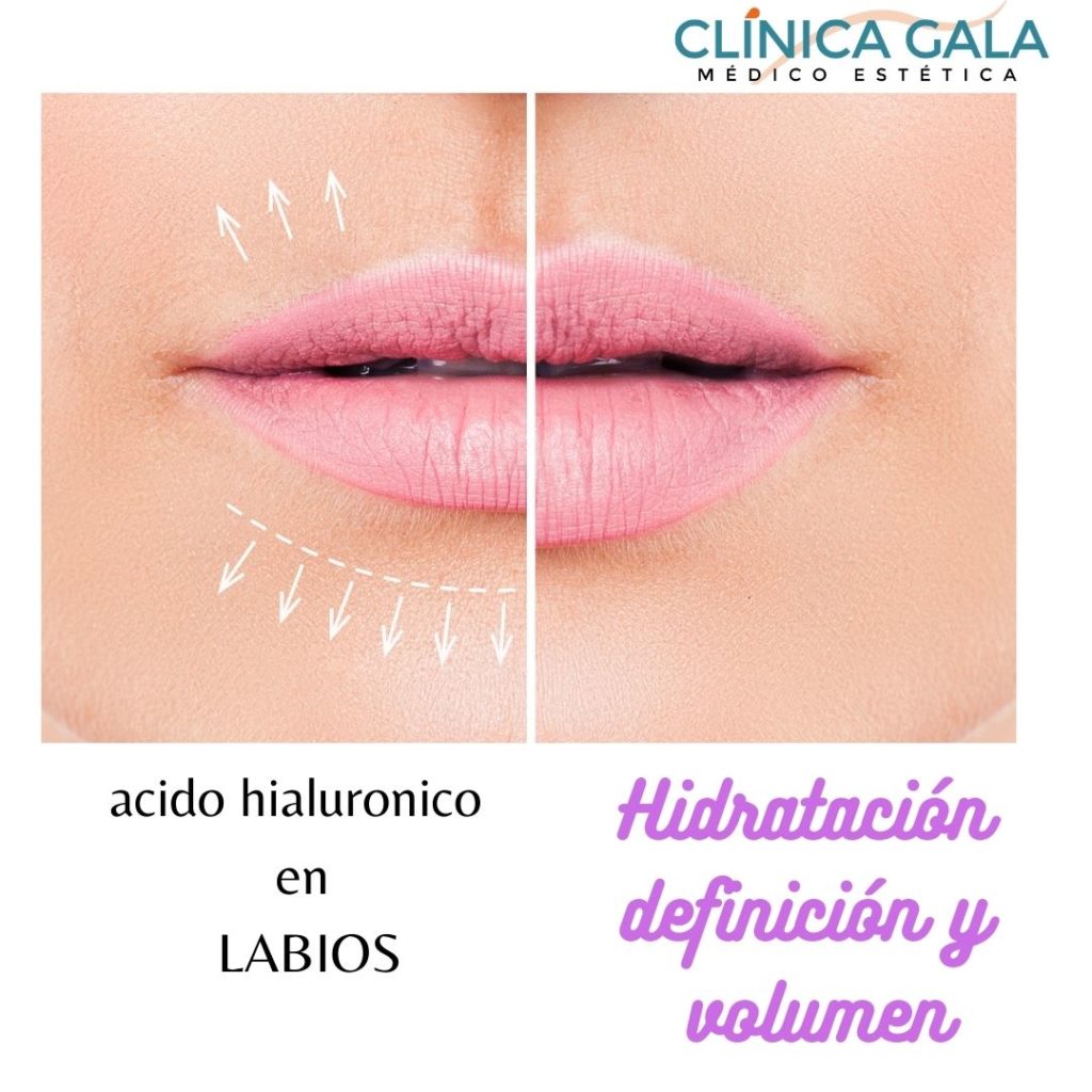 hidratación de labios – Clínica Gala